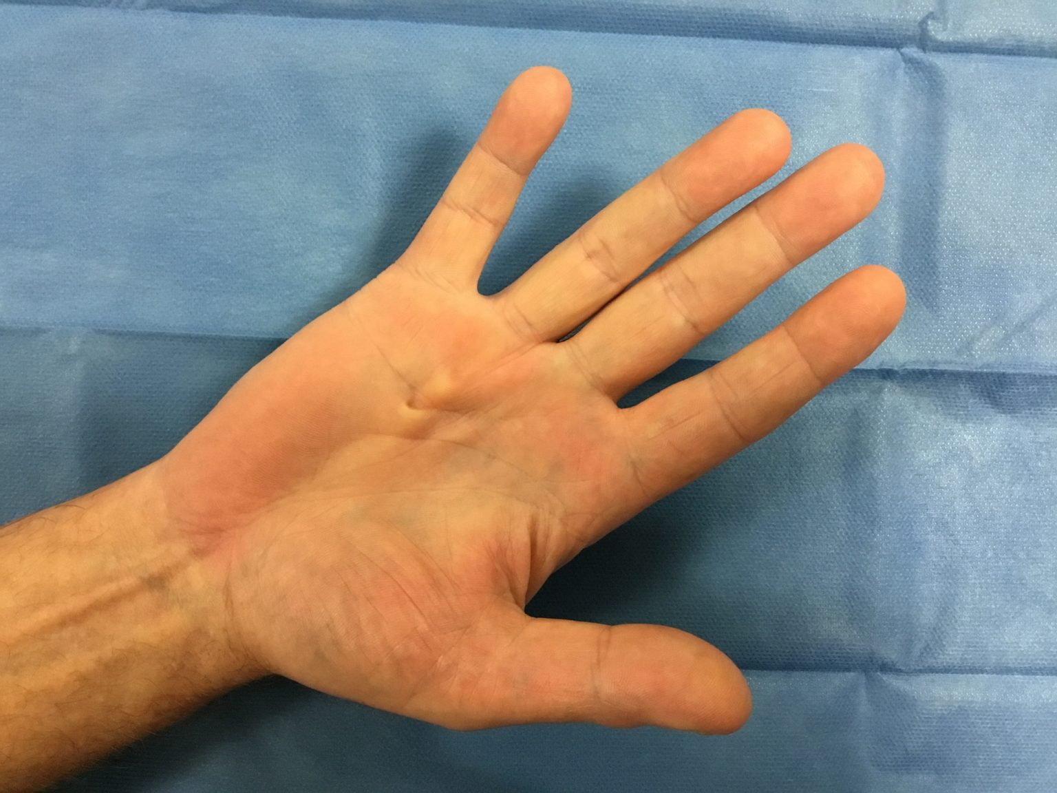 Dupuytren’s Disease - Mary O'Brien - Plastic and Hand Surgery