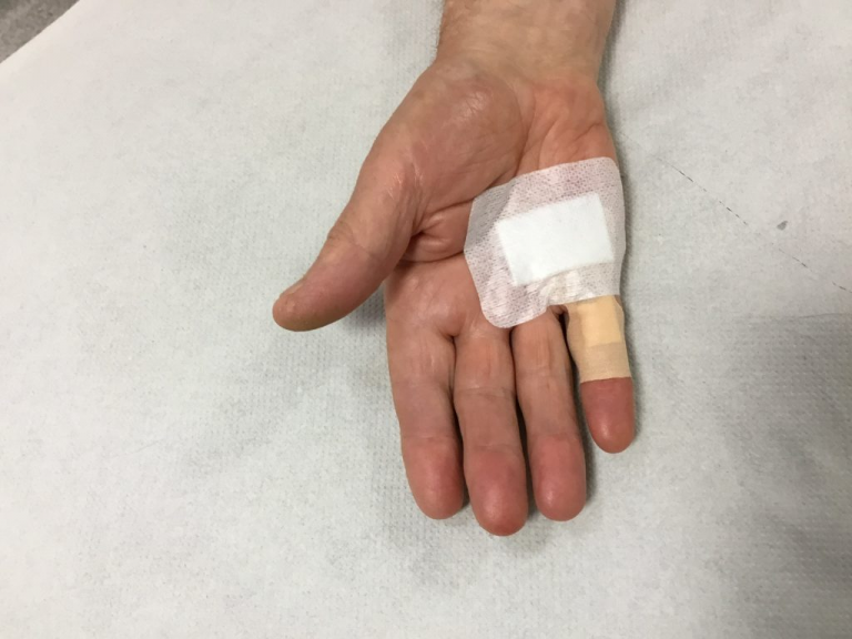 Dupuytren’s Disease - Mary O'Brien - Plastic and Hand Surgery
